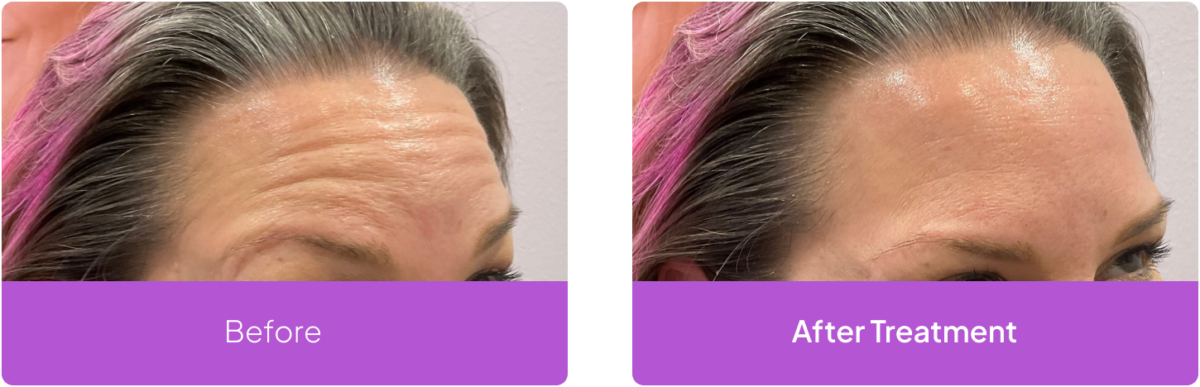 Laser Hair Removal @ Chic Derm & Aesthetics in Allen, TX