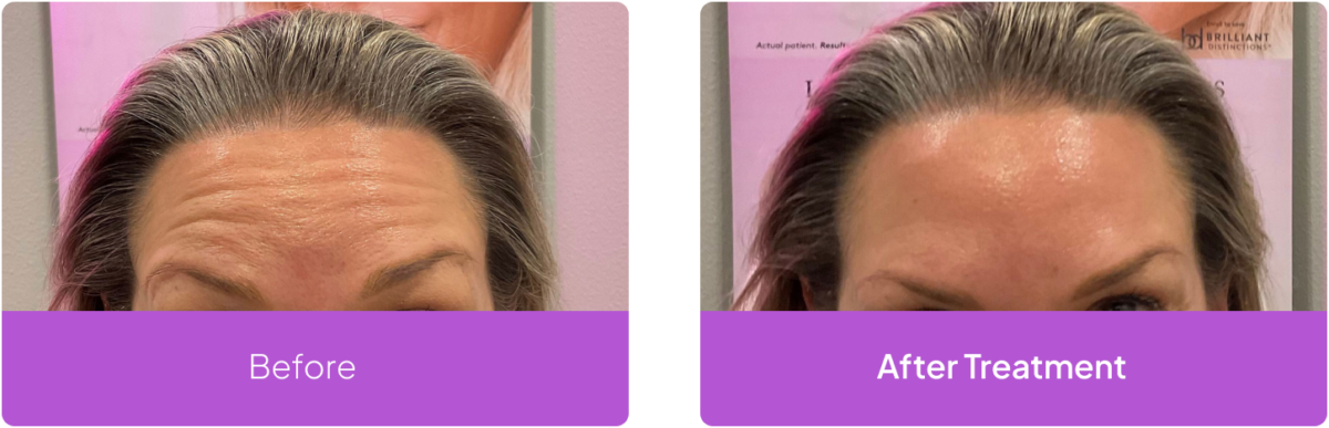 Botox in Allen, TX - Botulinum-toxin, Injectables, Fillers