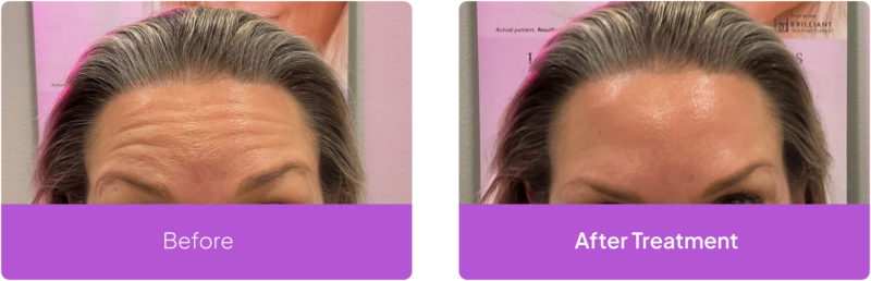 Laser Hair Removal @ Chic Derm & Aesthetics in Allen, TX