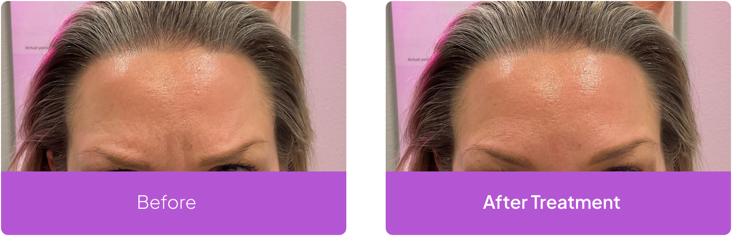 Laser Hair Removal @ Chic Derm & Aesthetics in Allen, TX
